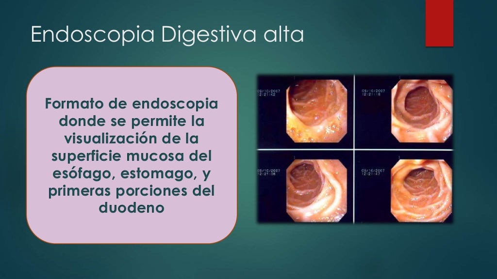 Endoscopia