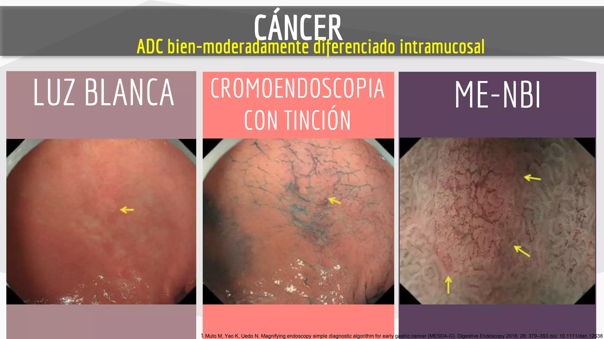 Endoscopia avanzada gastrica | PPT