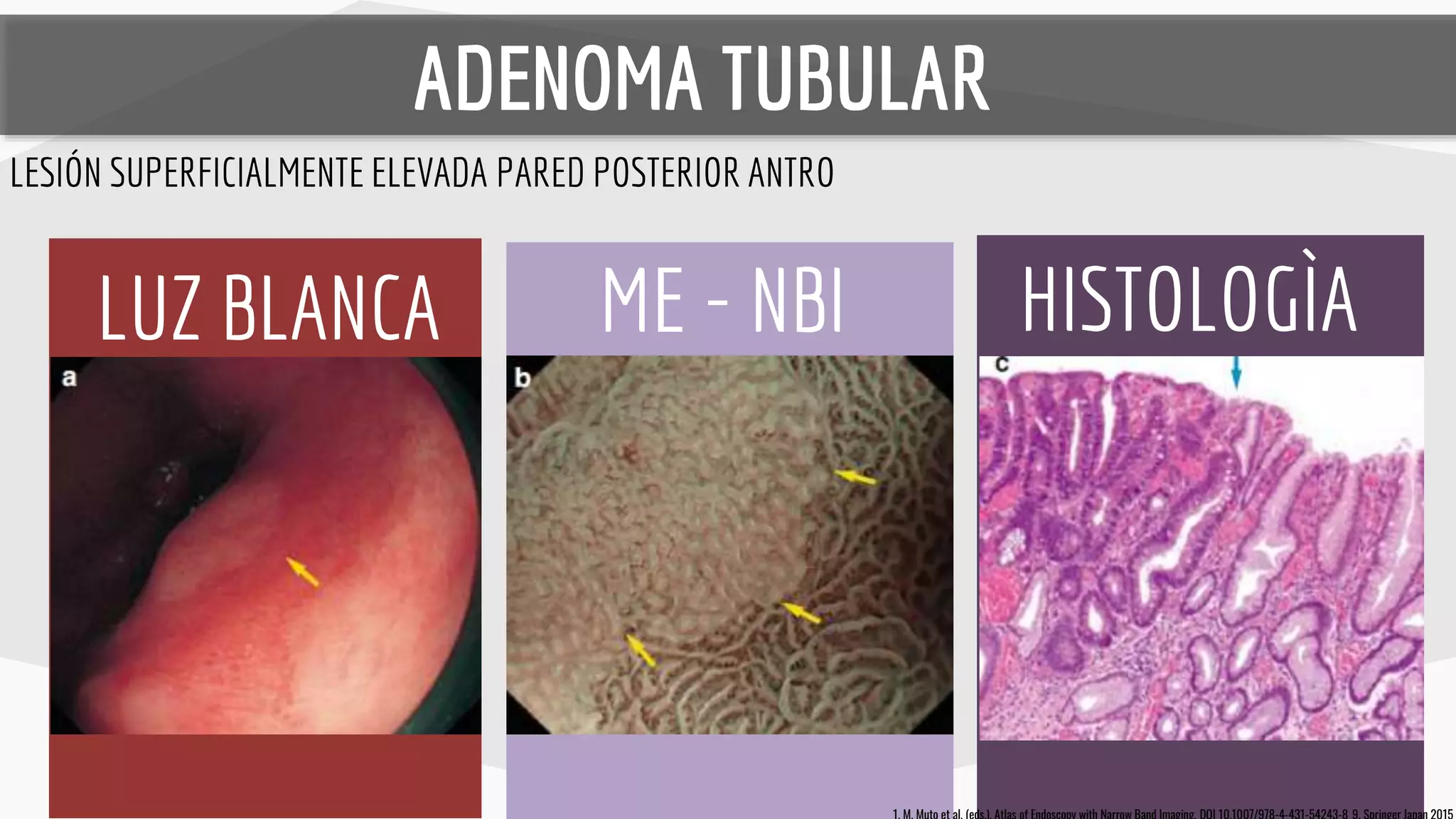 Endoscopia avanzada gastrica | PPT