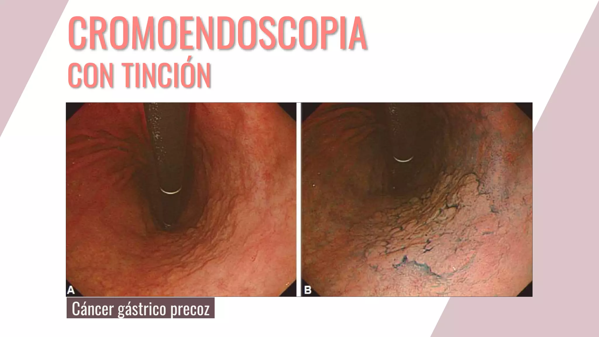 Endoscopia avanzada gastrica | PPT