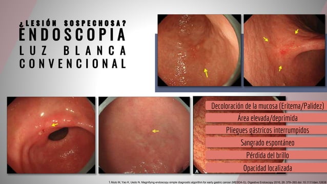 Endoscopia avanzada gastrica | PPT