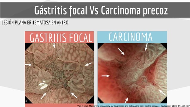 Endoscopia avanzada gastrica | PPT