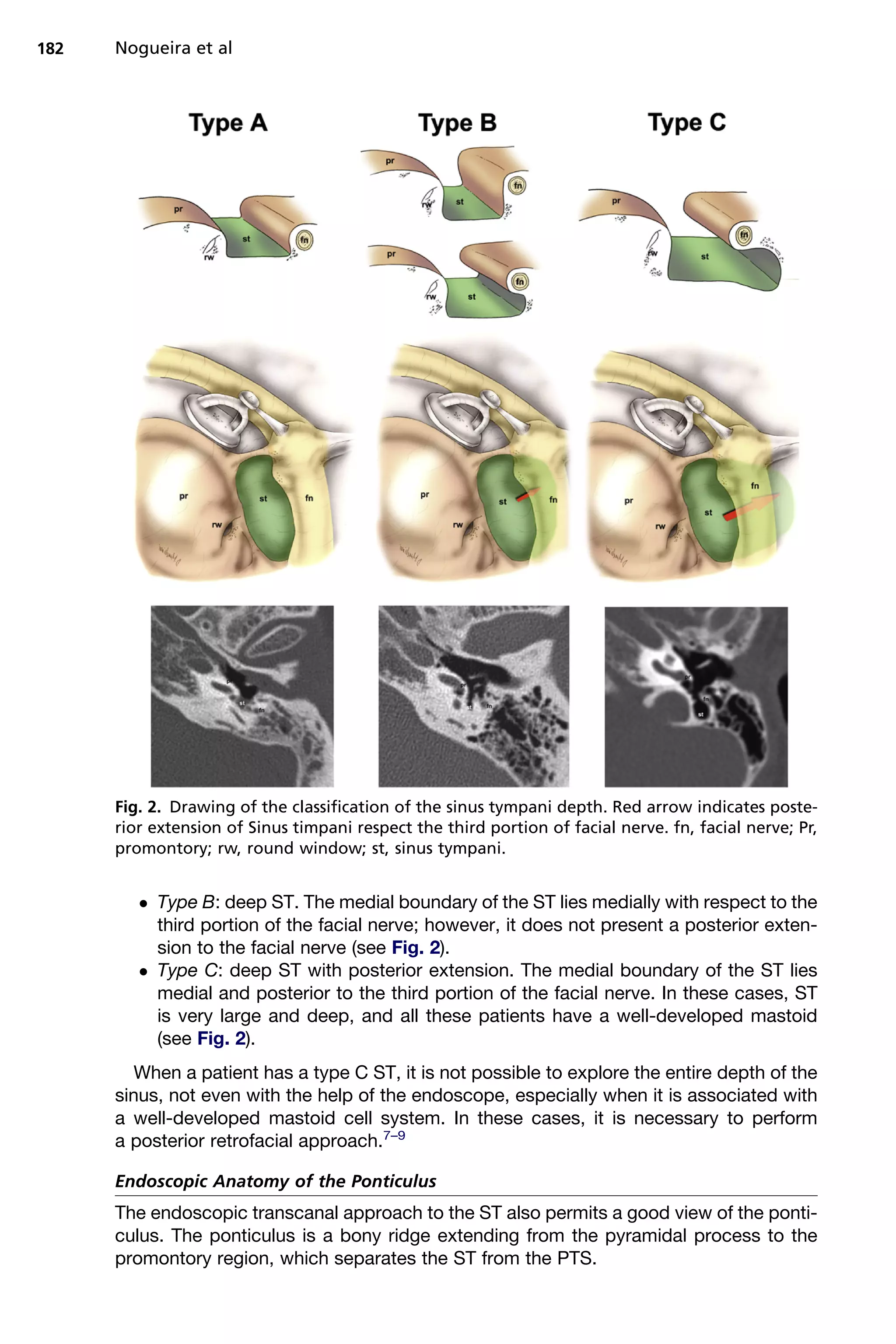 Endoscopic anatomy of Retrotympanum; Middle ear | PDF