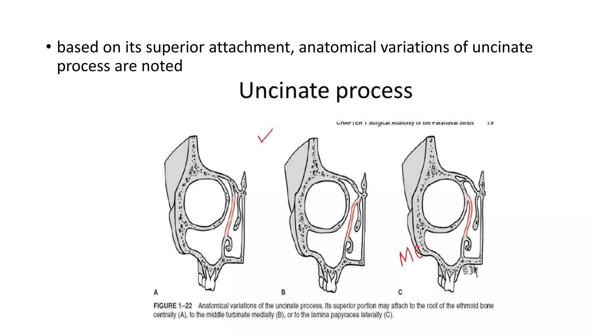 Endoscopic anatomy of ethmoid bone | PDF