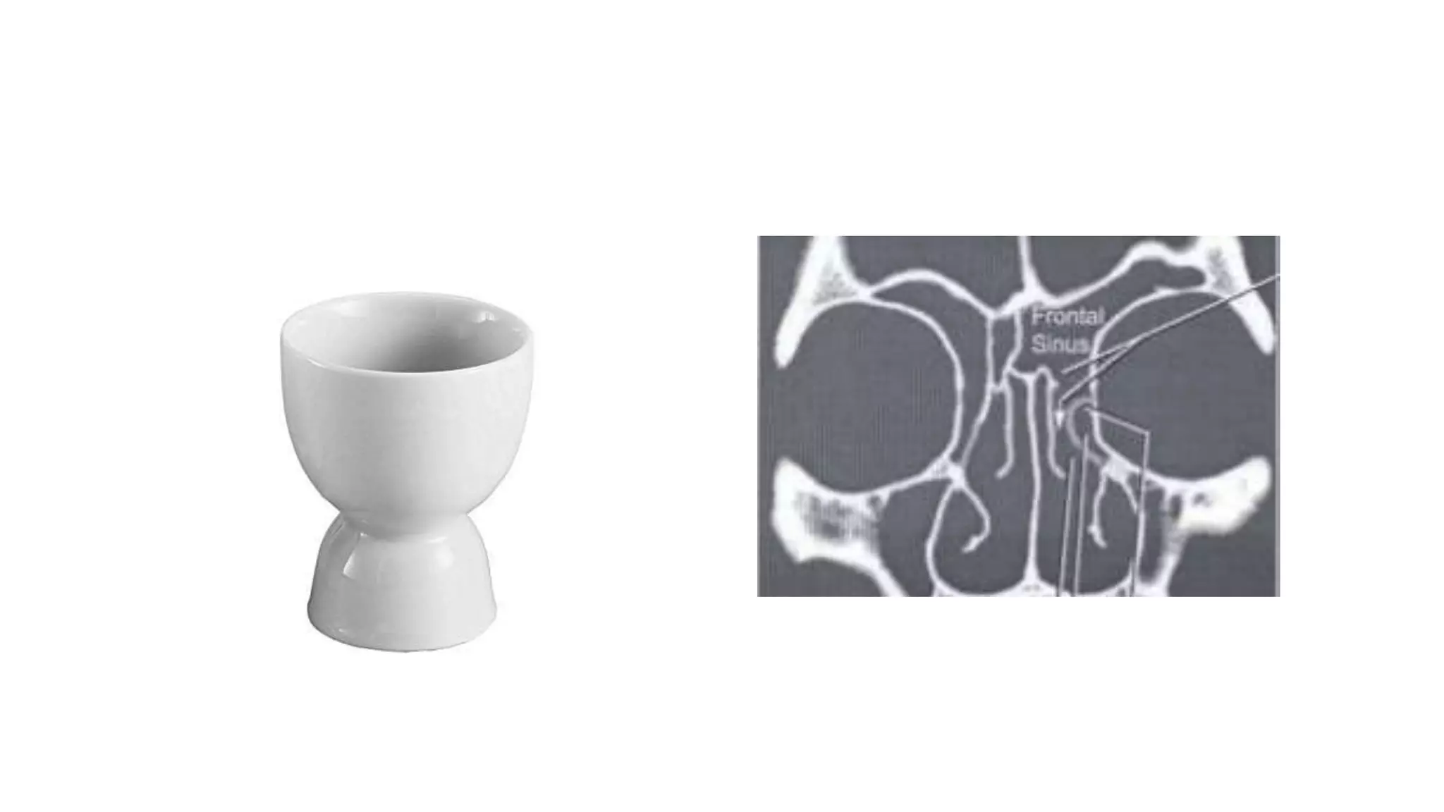 Endoscopic anatomy of ethmoid bone | PDF