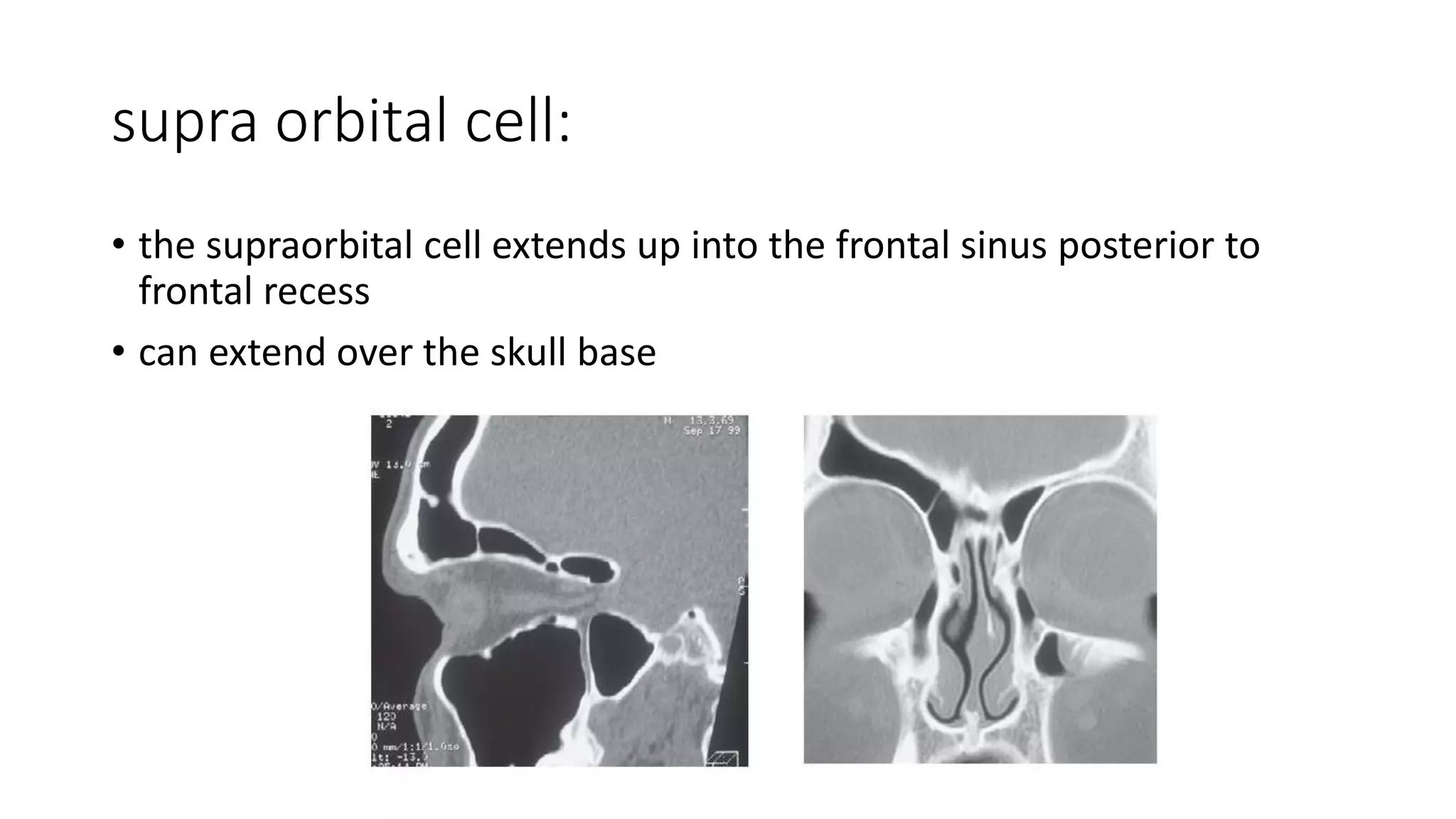 Endoscopic anatomy of ethmoid bone | PPT