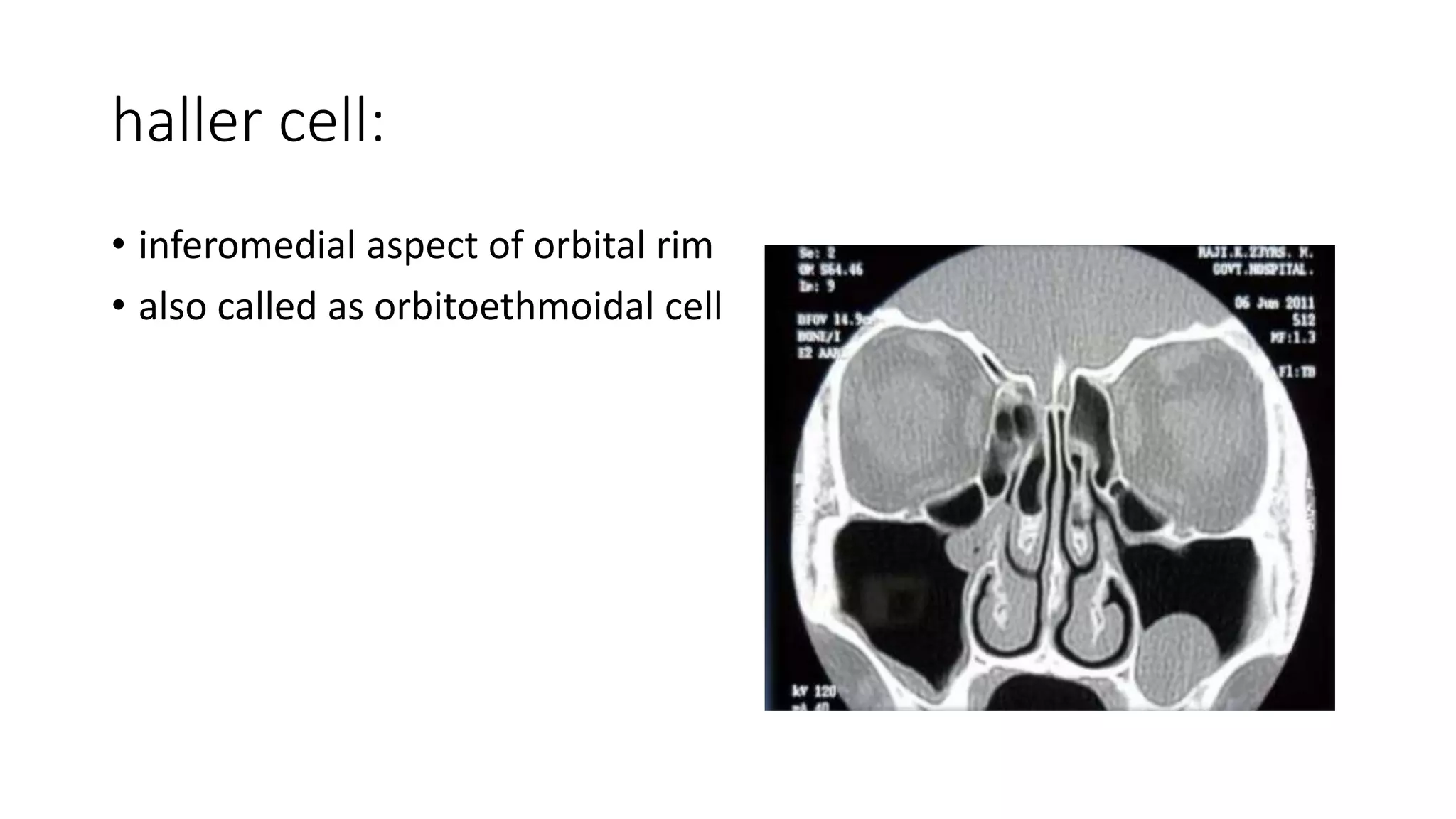 Endoscopic anatomy of ethmoid bone | PPTX