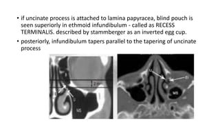 Ethmoid Infundibulum