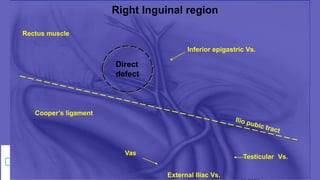 endoscopic anatomy of inguinal region.pptx