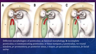 Endoscopic anatomy of middle ear.jshpptx | PPTX