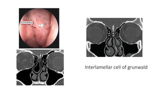 endoscopic anatomy of nasal cavity & paranasal sinuses.pptx