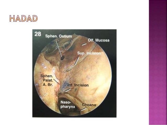 Endoscopic anatomy of nose and sphenoid sinus