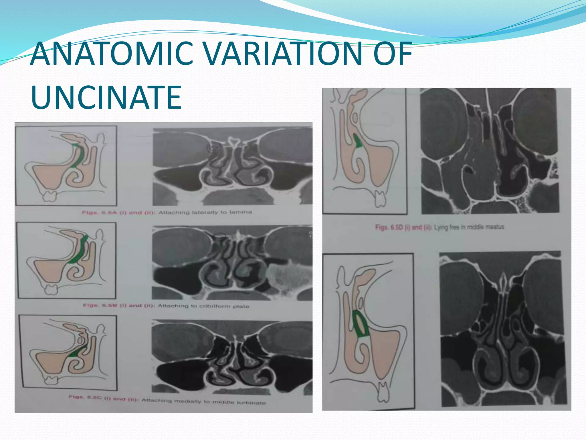 Endoscopic anatomy of nose ,paranasal sinus and anterior skull base | PPTX