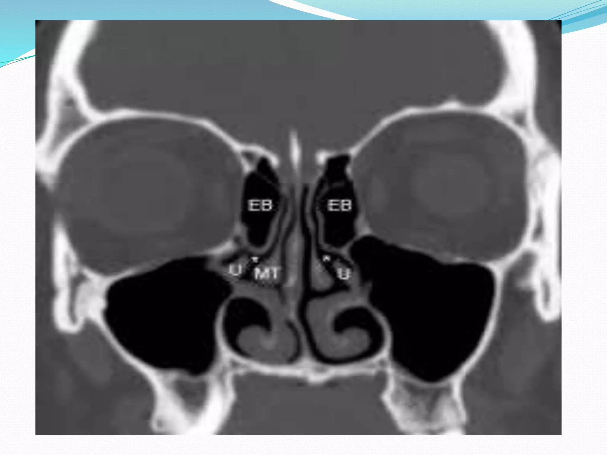 Endoscopic anatomy of nose ,paranasal sinus and anterior skull base | PPTX