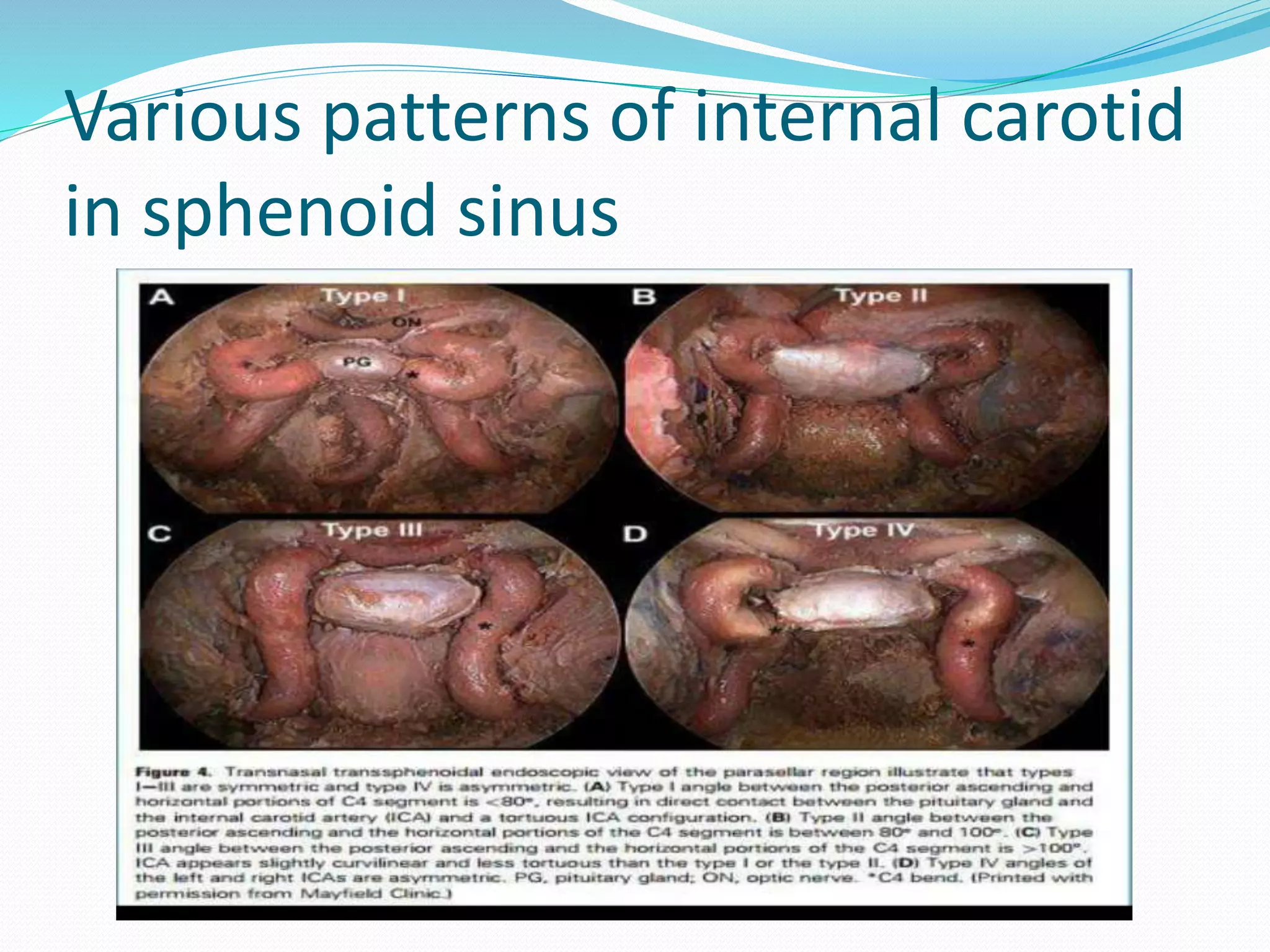 Endoscopic anatomy of nose ,paranasal sinus and anterior skull base | PPTX