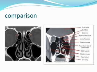 Endoscopic anatomy of nose ,paranasal sinus and anterior skull base | PPTX