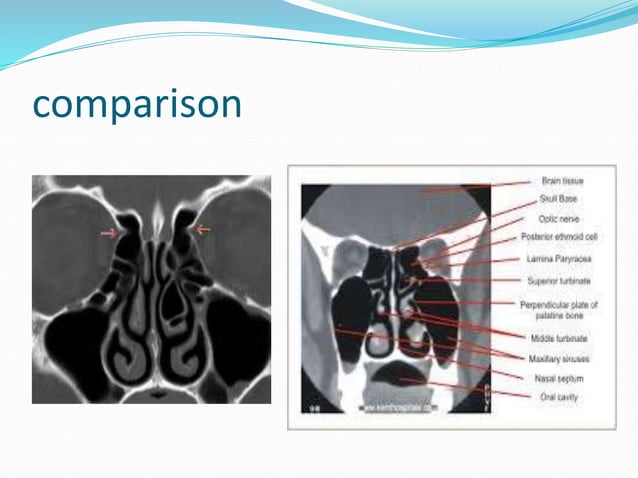 Endoscopic anatomy of nose ,paranasal sinus and anterior skull base ...