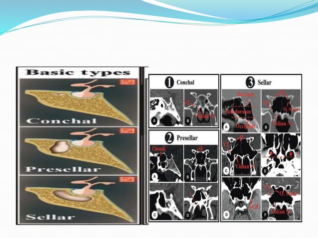Endoscopic anatomy of nose ,paranasal sinus and anterior skull base ...