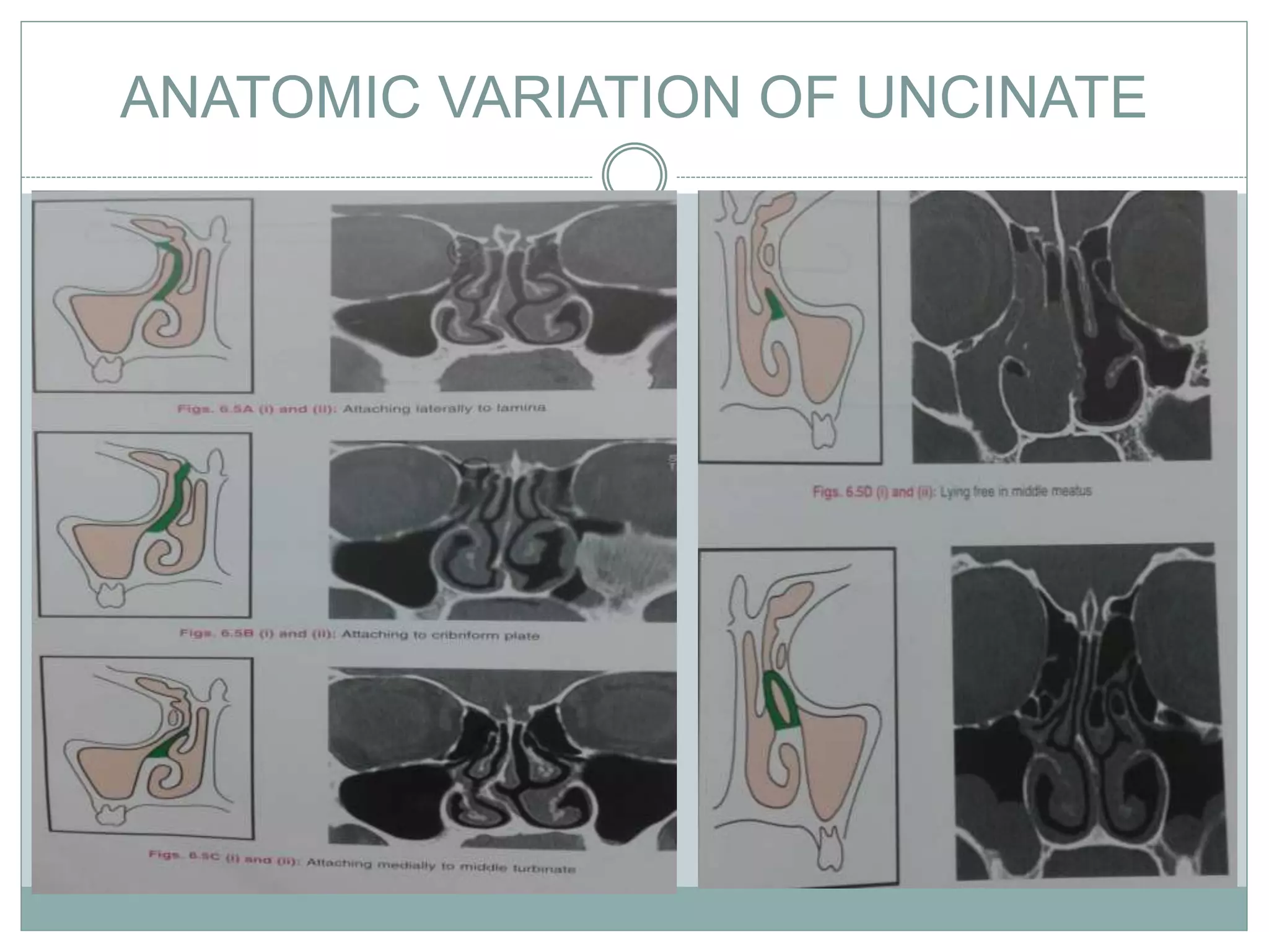 Endoscopic anatomy of nose and PNS | PPTX
