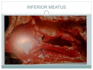 Endoscopic anatomy of nose and PNS | PPTX