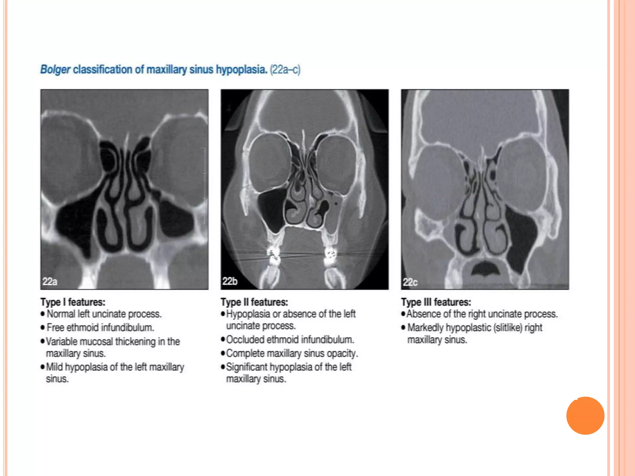 Endoscopic anatomy of Nose, PNS and anterior skull base | PPTX