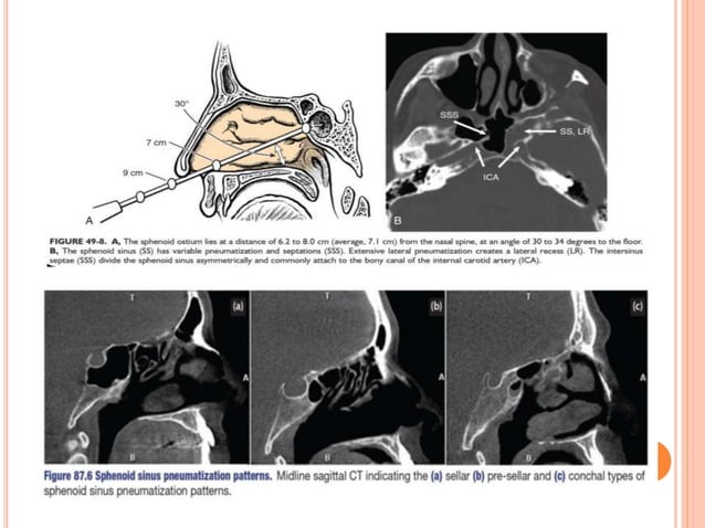 Endoscopic anatomy of Nose, PNS and anterior skull base | PPTX
