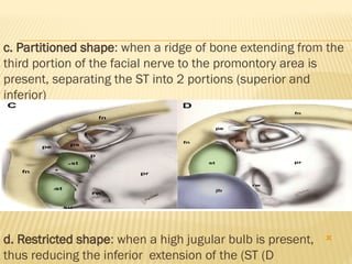 endoscopic anatomy of retrotympanum.pptx