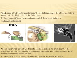 endoscopic anatomy of retrotympanum.pptx