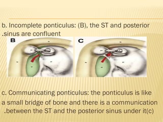endoscopic anatomy of retrotympanum.pptx