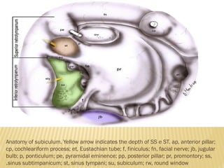 endoscopic anatomy of retrotympanum.pptx