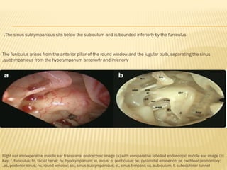 endoscopic anatomy of retrotympanum.pptx