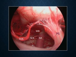 Endoscopic anatomy of lateral wall of sphenoid sinus | PPTX