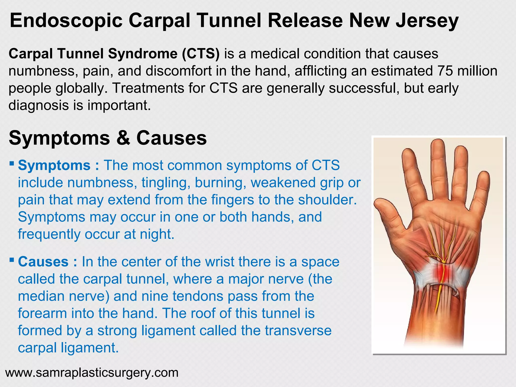 Endoscopic Carpal Tunnel Release NJ | PPT