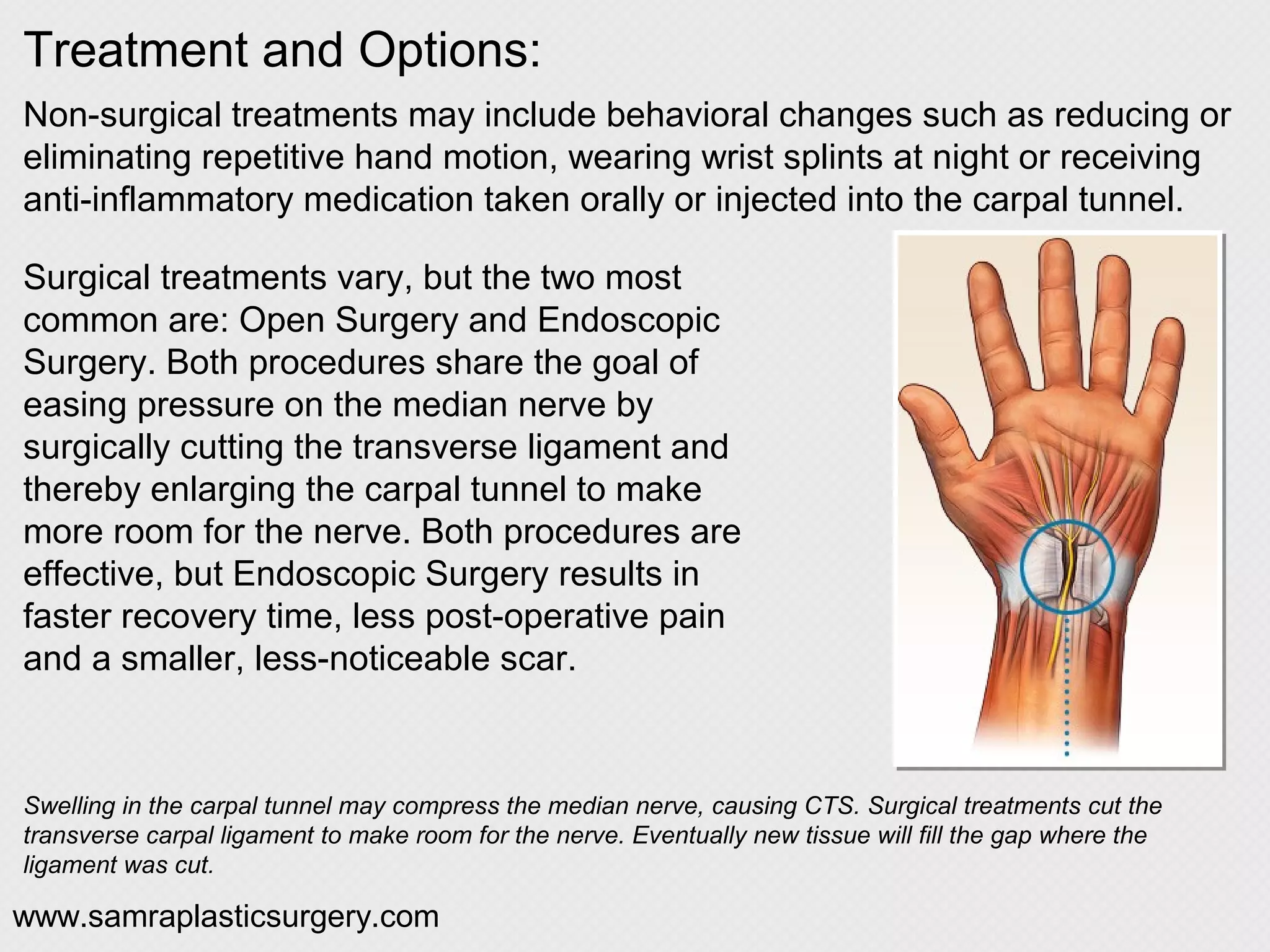 Endoscopic Carpal Tunnel Release NJ | PPT