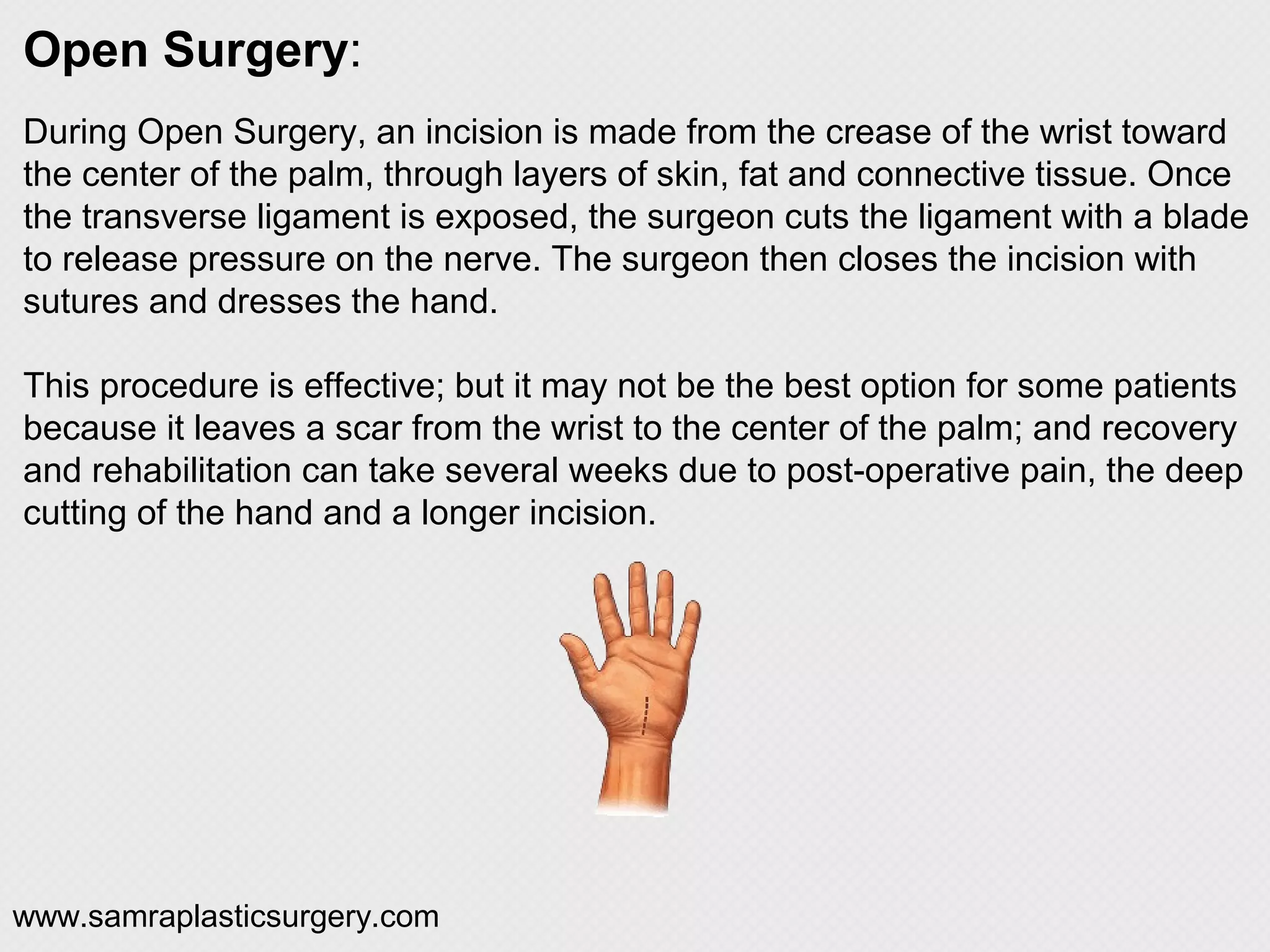 Endoscopic Carpal Tunnel Release NJ | PPT