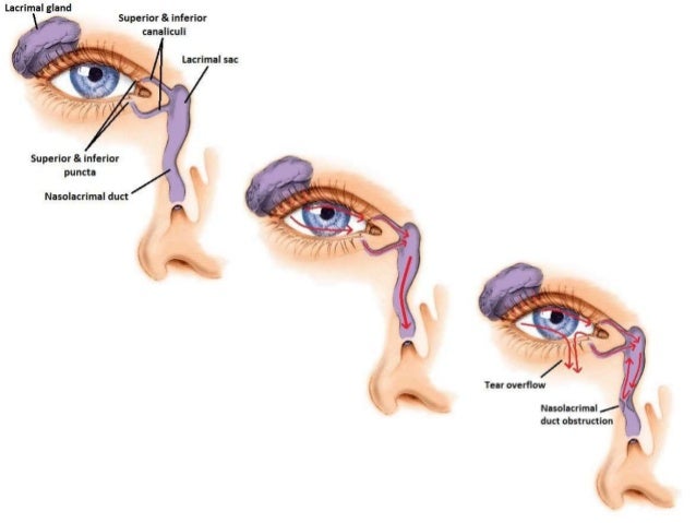 Endoscopic (DCR) Dacryocystorhinostomy