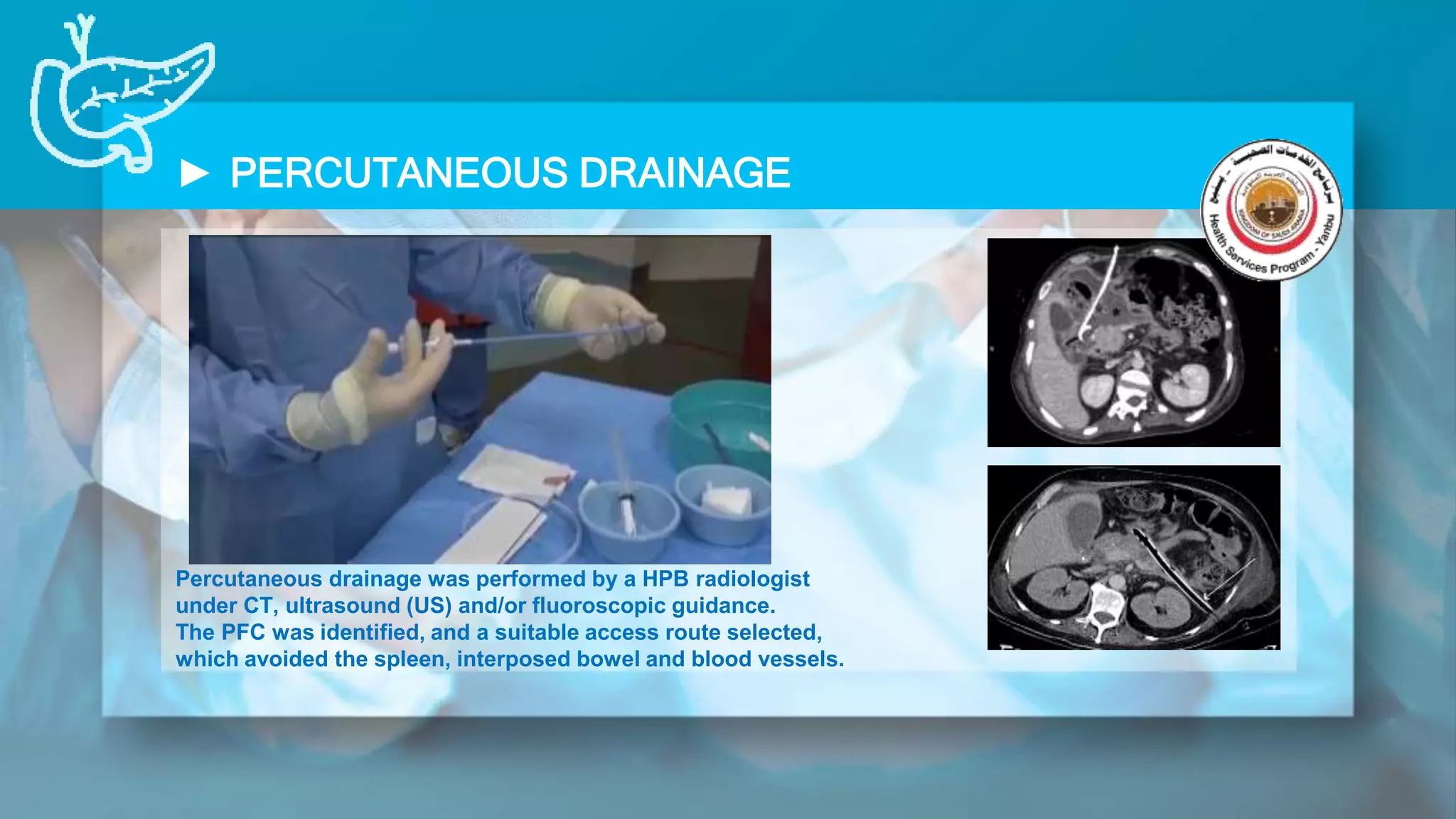 Endoscopic drainge of pancreatic absces inchildren | PPTX