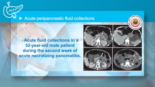 Endoscopic drainge of pancreatic absces inchildren | PPT