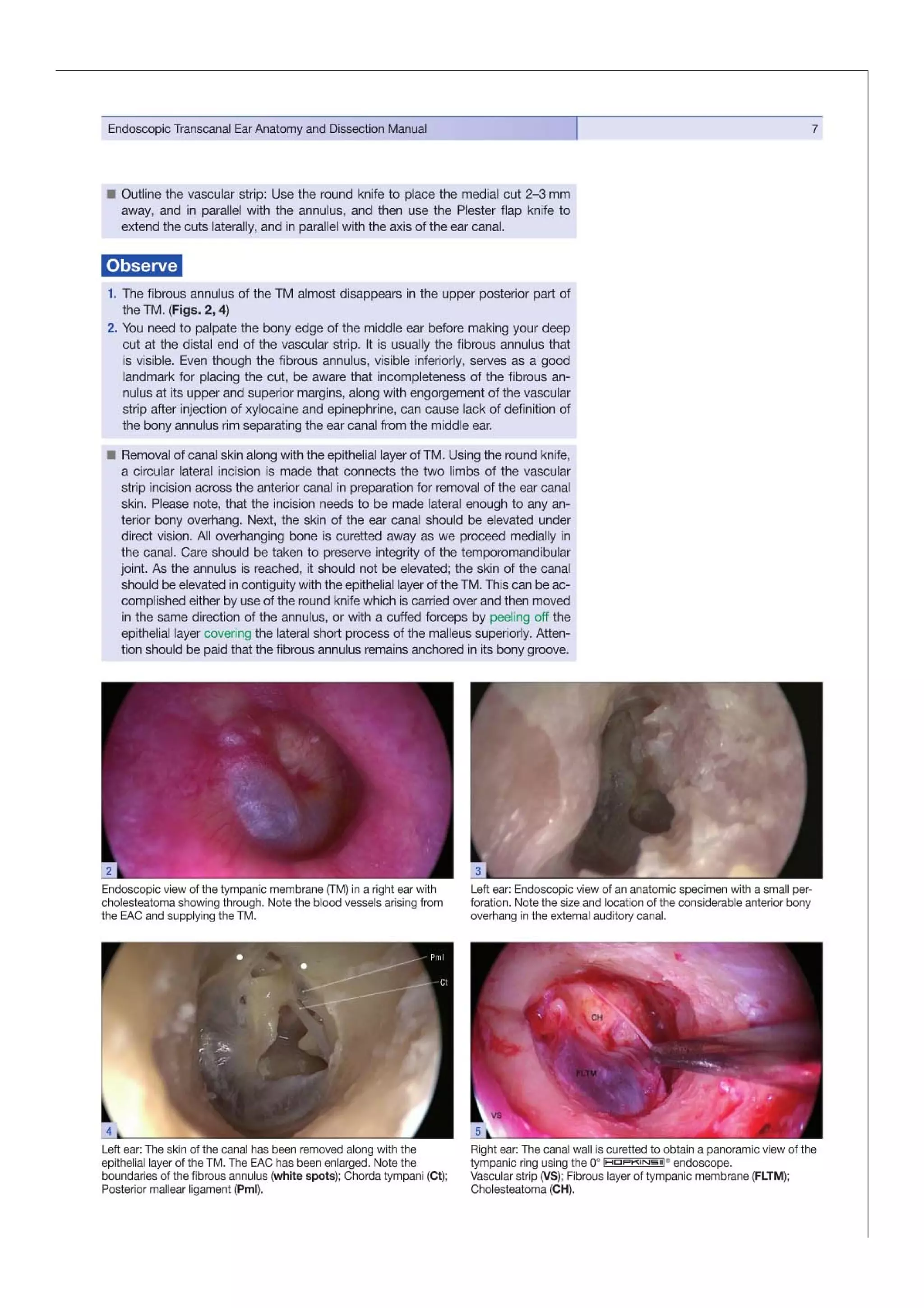 Endoscopic ear anatomy & Dissection | PDF | Ear, Nose and Throat ...