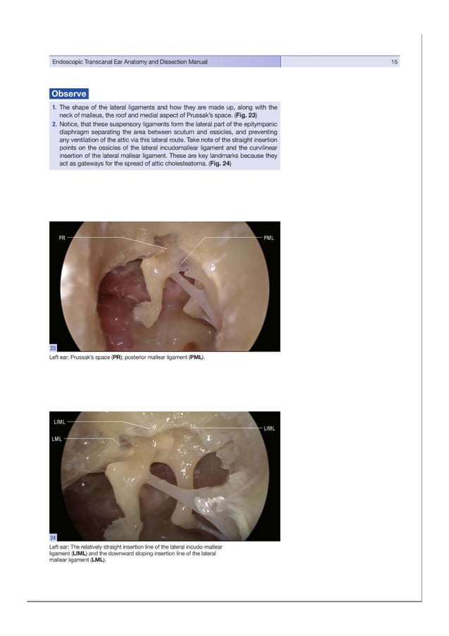 Endoscopic ear anatomy & Dissection | PDF | Ear, Nose and Throat ...