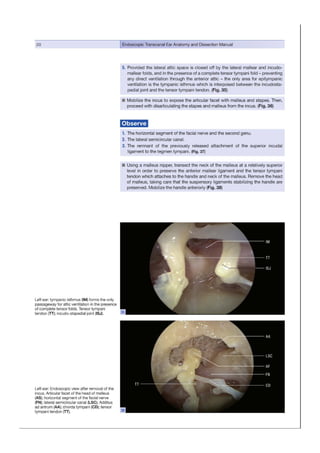 Endoscopic ear anatomy & Dissection | PDF