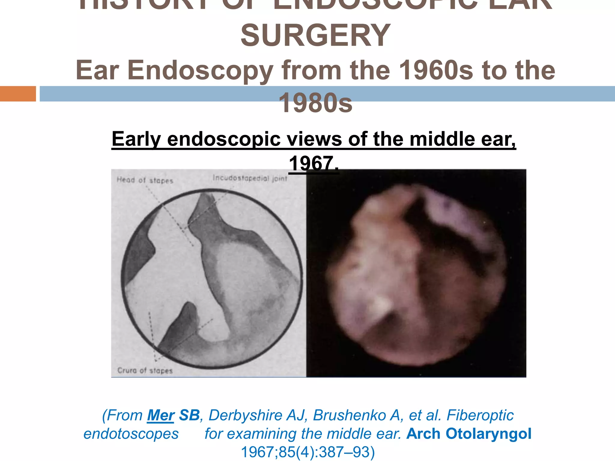 Endoscopic ear surgery | PPTX