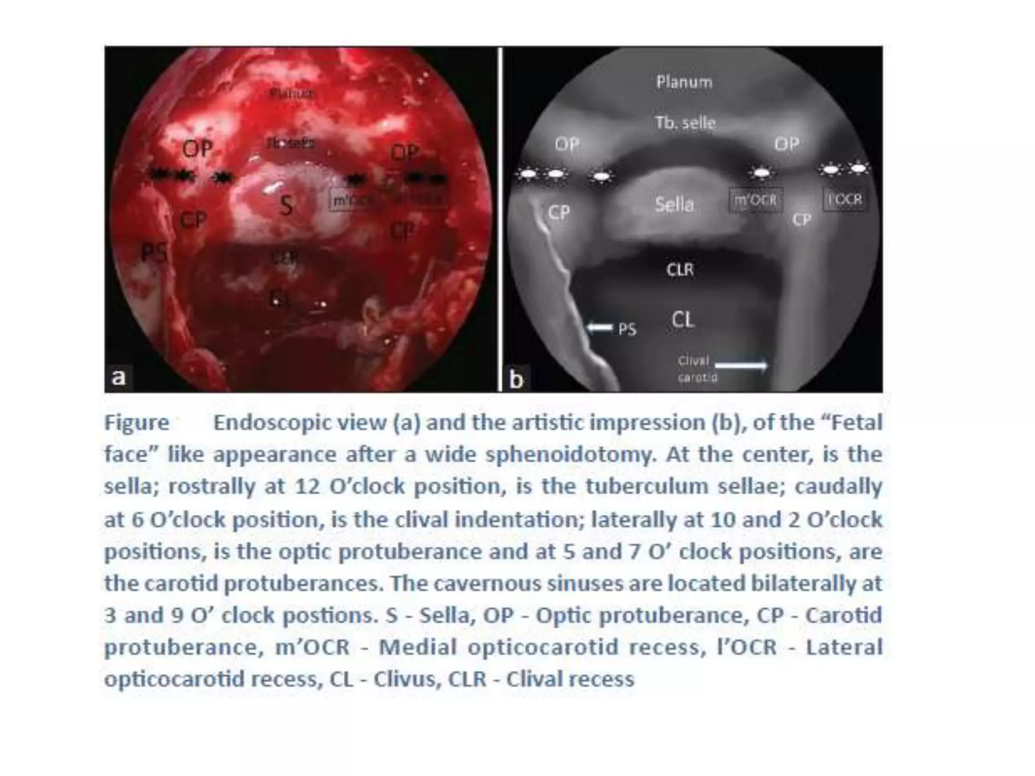 Endoscopic Endonasal Anatomy.pptx