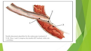 Endoscopic injection in VUR | PPT