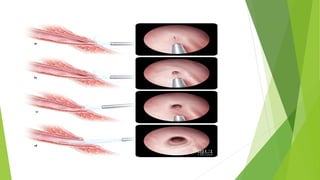 Endoscopic injection in VUR | PPT