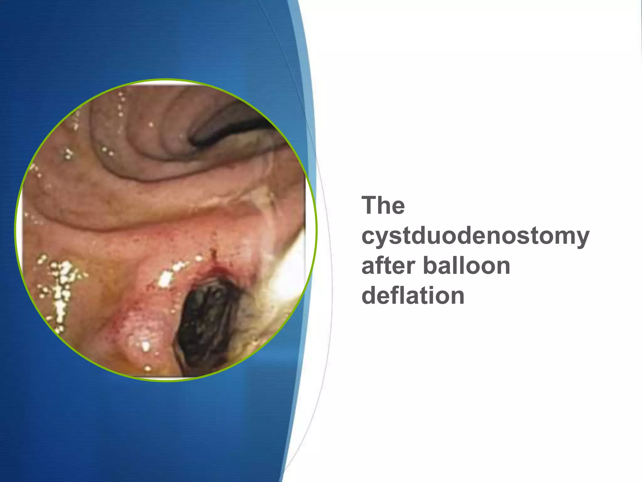 Endoscopic management of walled of pancreatic necrosis | PPTX