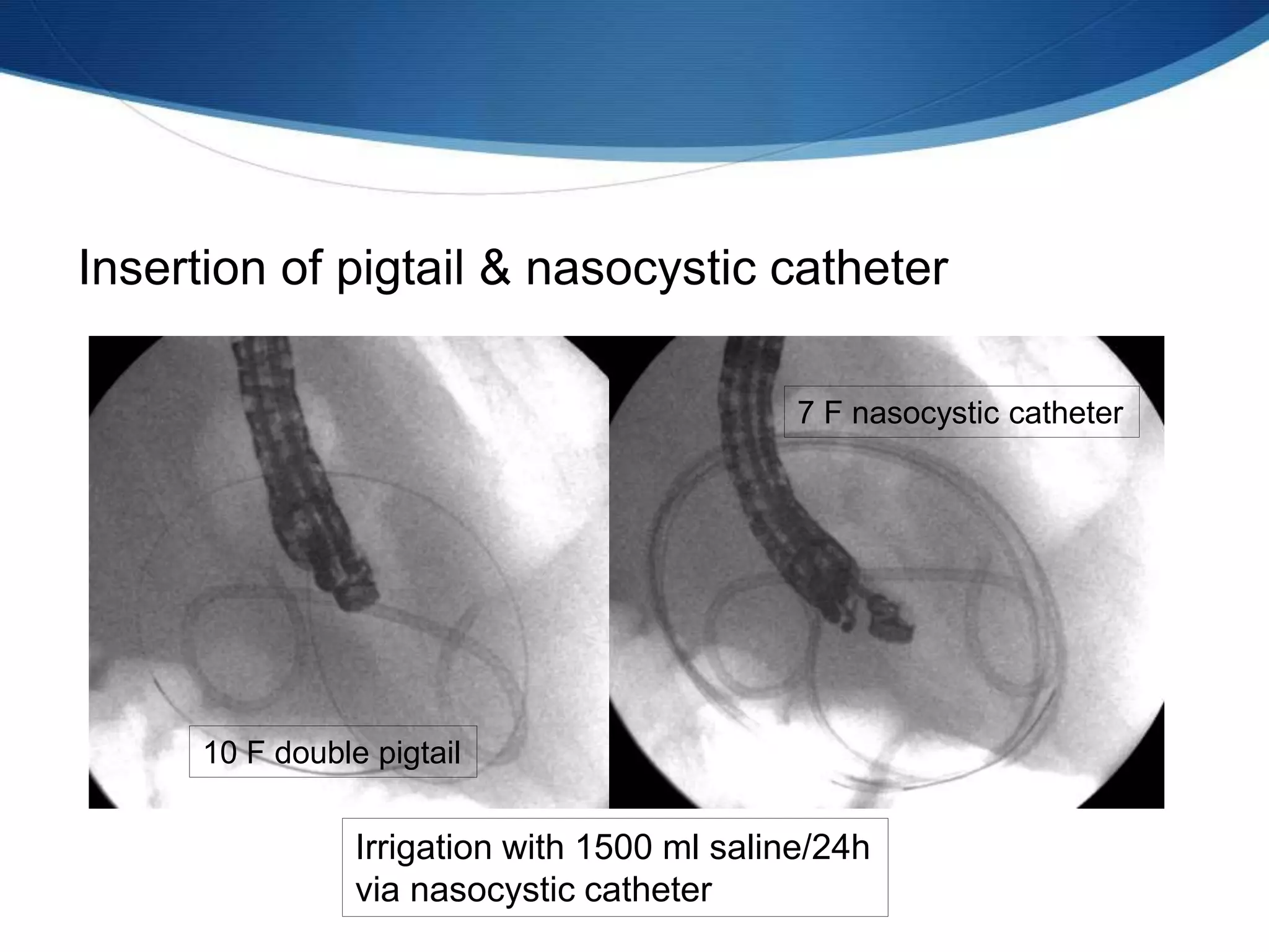 Endoscopic management of walled of pancreatic necrosis | PPTX