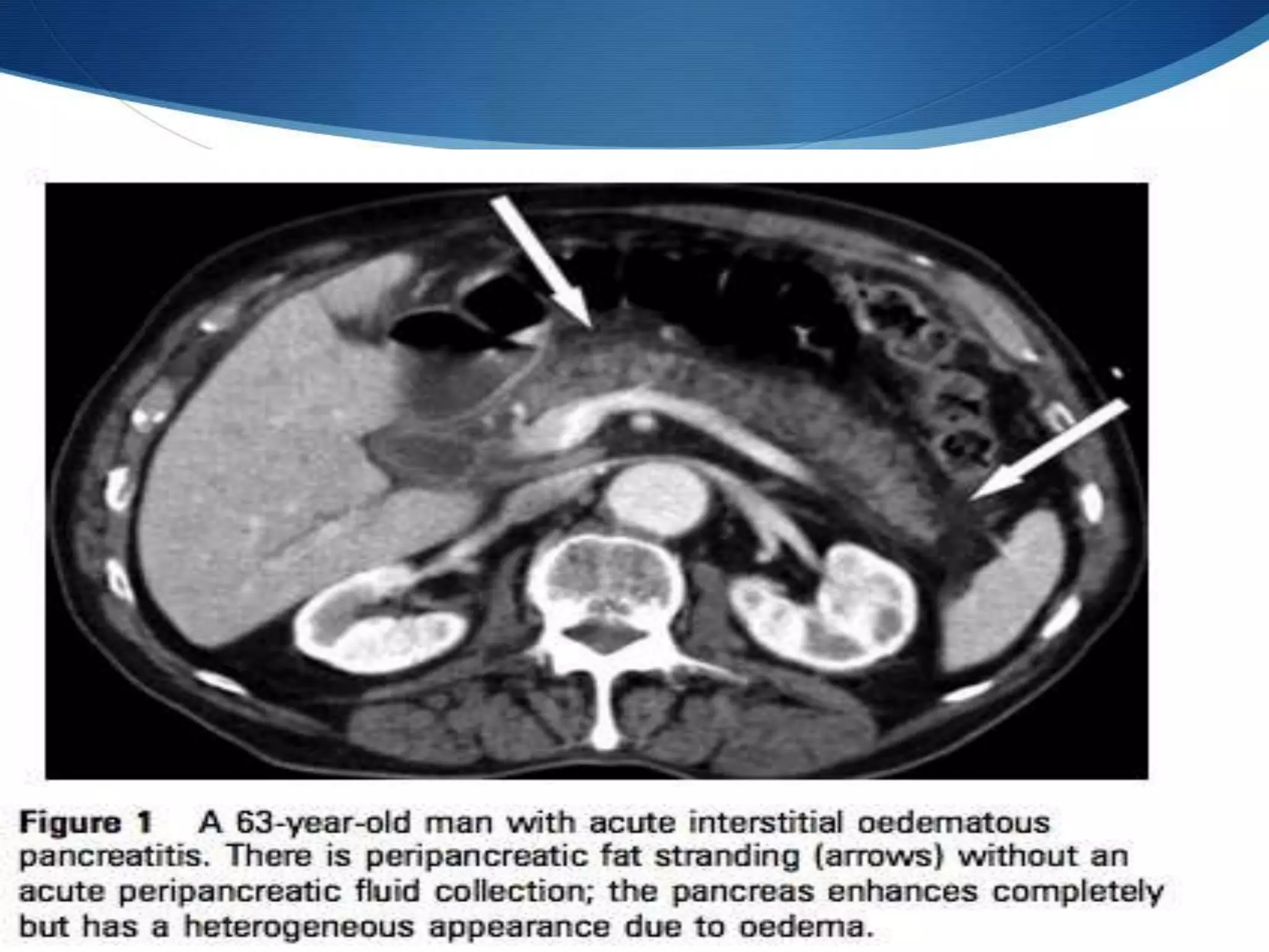 Endoscopic management of walled of pancreatic necrosis | PPTX