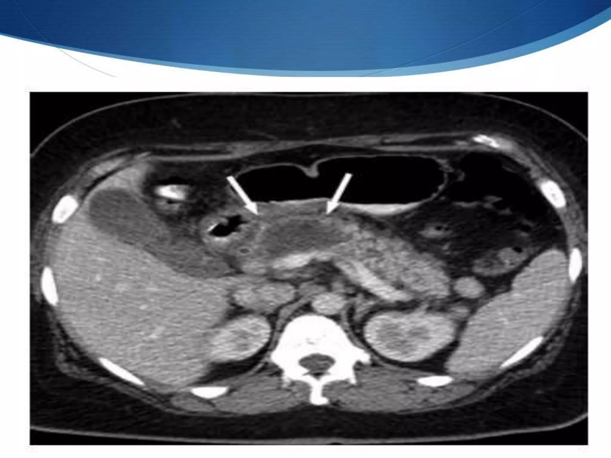 Endoscopic management of walled of pancreatic necrosis | PPTX