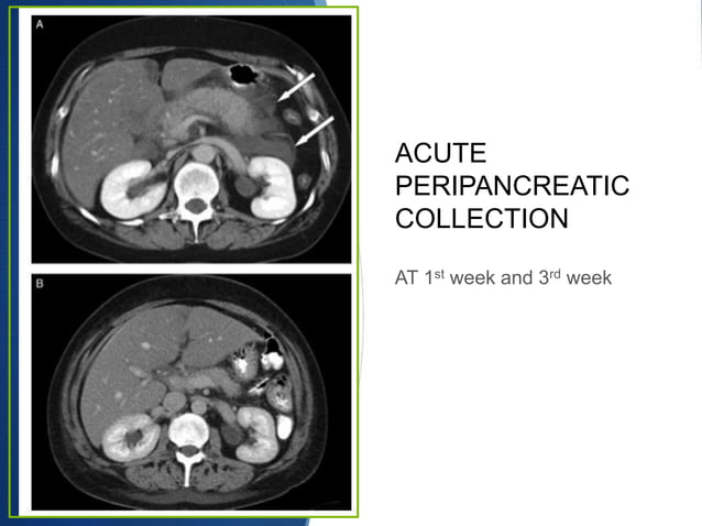 Endoscopic management of walled of pancreatic necrosis | PPTX ...
